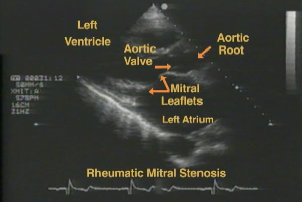 mitral stenosis echo